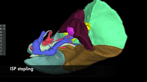 3d Ds Ep 6 Left S8 Segmentectomy Karel Pfeuty