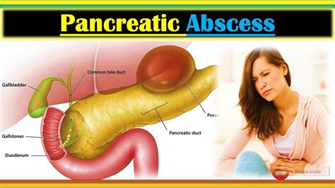 Pancreatic Abscess Causes Sign And Symptoms Treatment Of