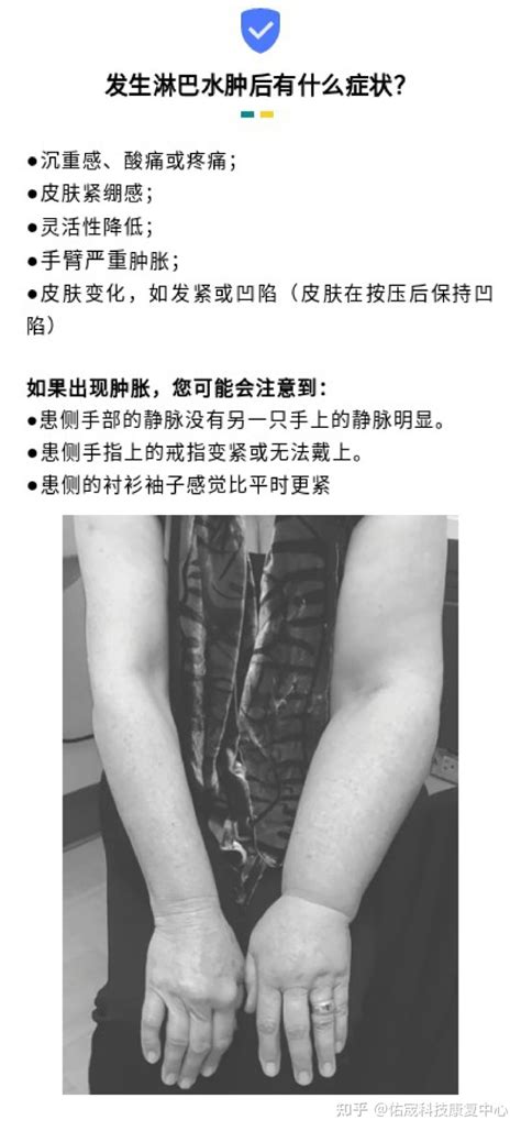 乳腺癌术后淋巴水肿康复指南 知乎