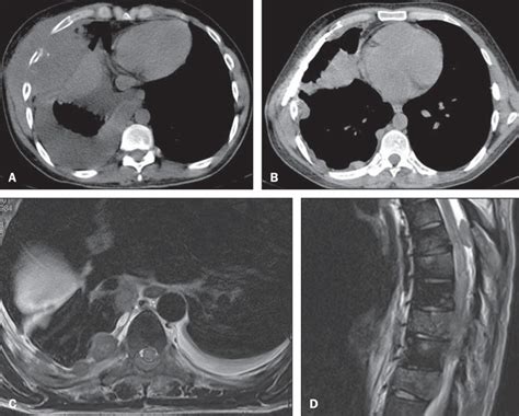 Peripheral Primitive Neuroectodermal Tumor Of Chest Wall In Young Adult Pmc