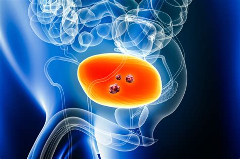 En Bloc Vs Standard Resection Found To Lower Bladder Cancer Recurrence
