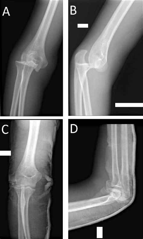 A B Plain Elbow Radiographs Demonstrate A Posterolateral Dislocation Download Scientific
