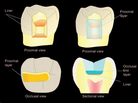 Figure 1 From Marginal Adaptation Of Direct Class Ii Composite Restorations With Different