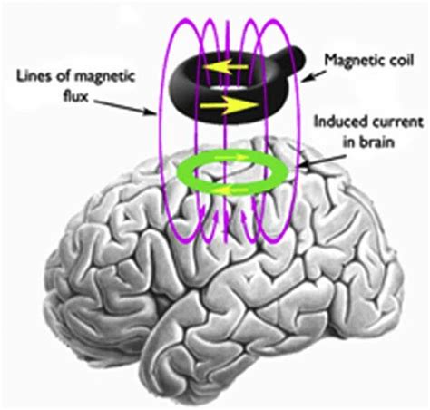 7 A Tms Coil Suspended Over The Brain 2 Download Scientific Diagram