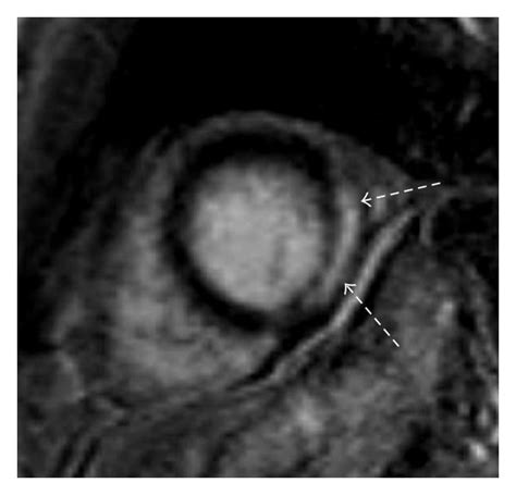 Lge Imaging In A Patient With A History Of Myocarditis There Are