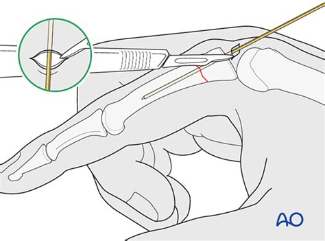 Intramedullary Screw Fixation For Transverse Extraarticular Fracture Of The Proximal End Segment