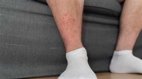 What Is Hiker S Rash And Is It Serious Advnture