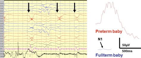 Preterm Eeg A Multimodal Neurophysiological Protocol