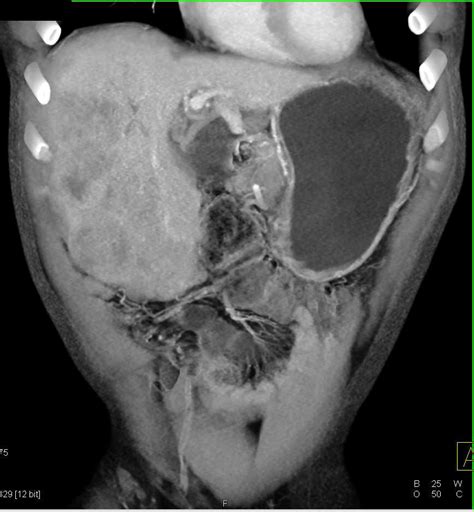 Multifocal Cholangiocarcinoma Liver Case Studies Ctisus Ct Scanning