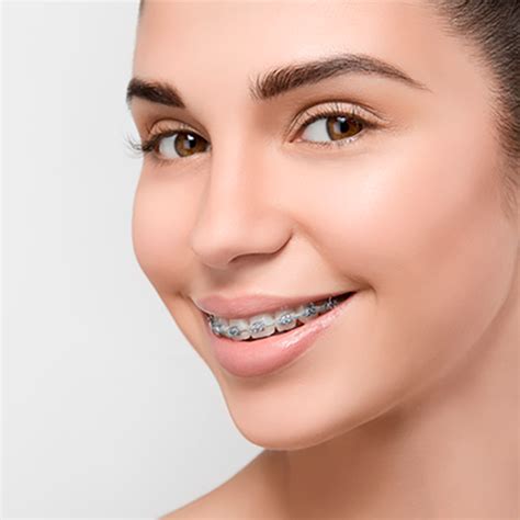 Cuánto Cuestan Los Brackets ¿cuál Es El Costo Real