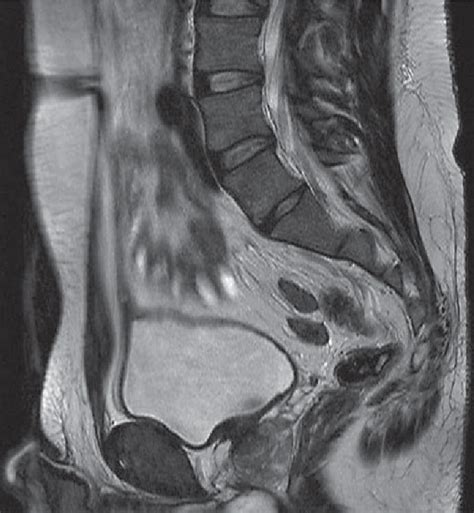 Figure 1 From Laparoscopic Management Of Patent Urachus In An Adult Man Semantic Scholar