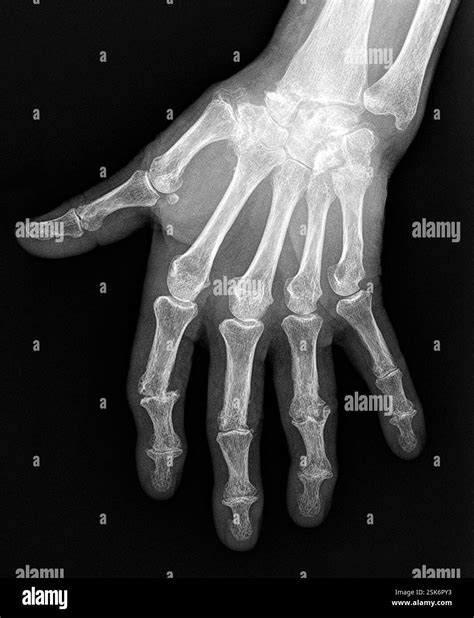 Arthritic Hand X Ray Of A Section Through The Left Hand Of A 52 Year