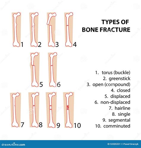 Bones Fractures Stock Vector Illustration Of Background 53305331