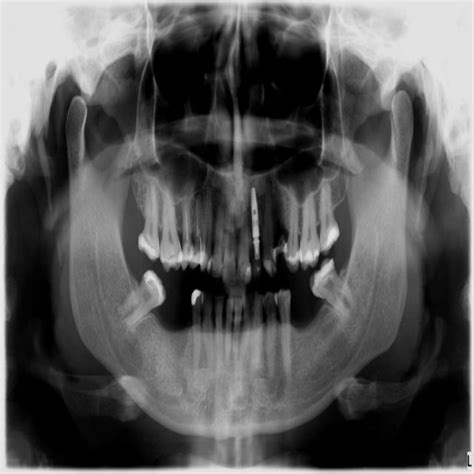 Dental Implants Object Detection Dataset And Pre Trained Model By National Taipei University