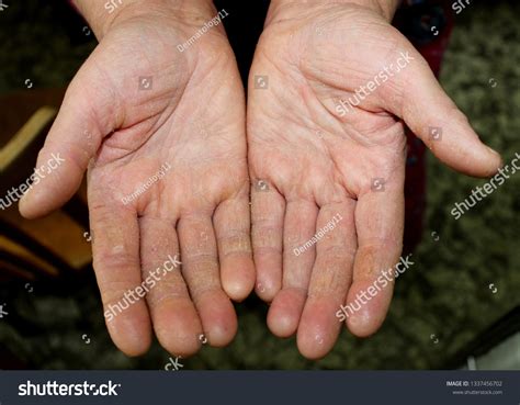 Keratoderma Climactericum