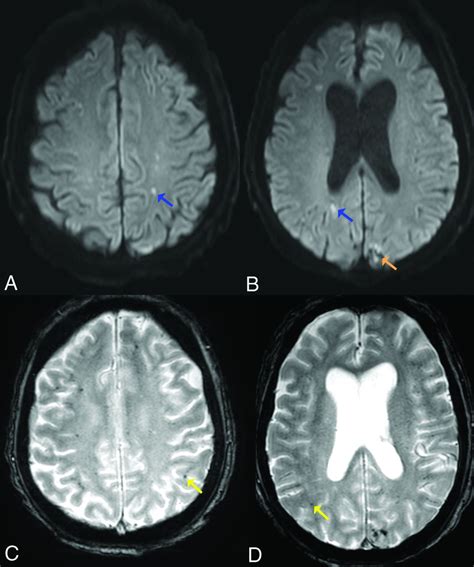 Mri Brain Normal Vs Abnormal