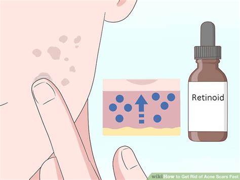 Ways To Get Rid Of Acne Scars Fast WikiHow