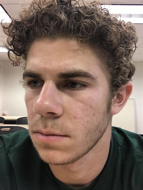 Skin Concerns What Is Causing These Deep Lines Under My Eyes And What Can I Do To Get Rid Of