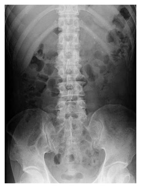 Intussusception Of Rectosigmoid Colon Cancer Mimicking A Pedunculated Tumor Pmc