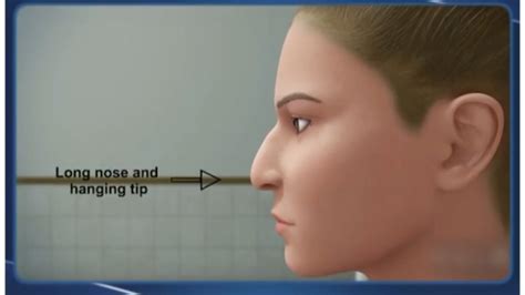 جراحی بینی استخوانی دکتر شادی جوادی