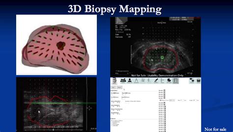 3dbiopsy™ Transperineal Mapping Biopsy In 2019