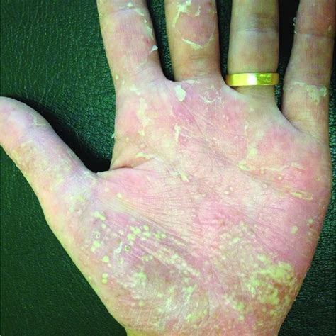 Pustular Lesions In A Erythematous And Scaling Plaque Affecting The Download Scientific Diagram