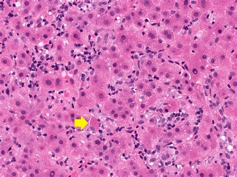 Autoimmune Hepatitis Lft Pattern At Aaron Levine Blog