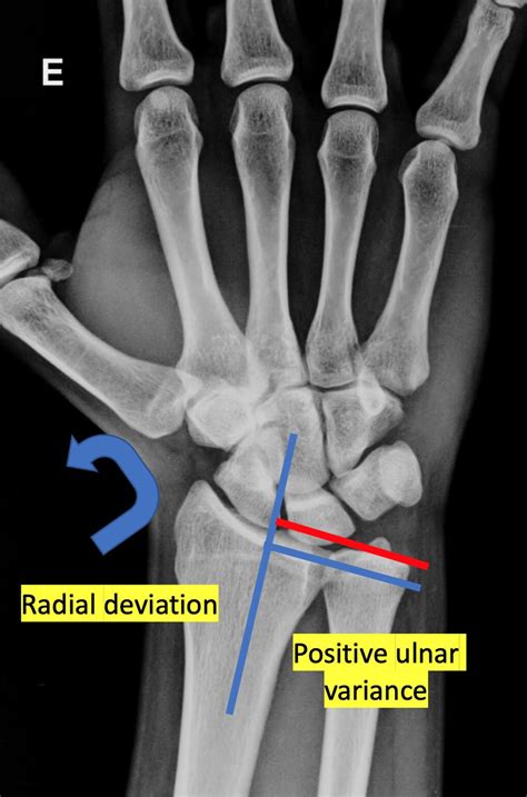 Ulnar Deviation X Ray