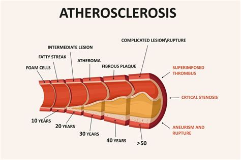 Penyakit Aterosklerosis Gejala Penyebab Pengobatan
