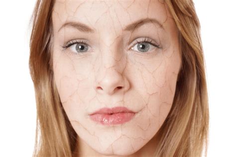 Oily Skin Causes Management And Treatment Heidi Salon