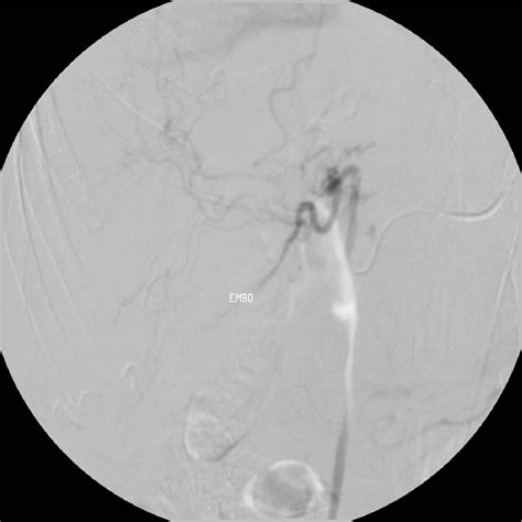Figure 1 From Trans Arterial Chemoembolization Tace Of Liver Metastases From Colorectal Cancer