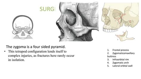 Zmc Fractures And Management Ppt