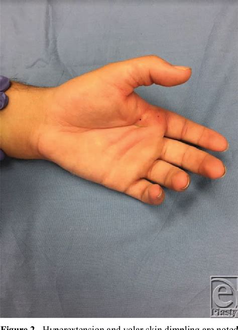 Figure 2 From Complex Metacarpophalangeal Dislocation Semantic Scholar