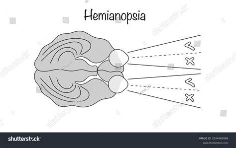 1 Hemianopsia Stock Vectors And Vector Art Shutterstock