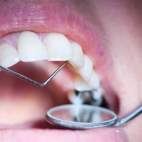 Mercury Poisoning Skin Rash