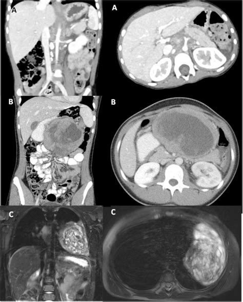 Lymphatic Embolization For The Management Of Post Operative Chyle Leaks
