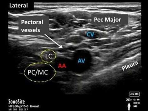 Infraclavicular Nerve Block