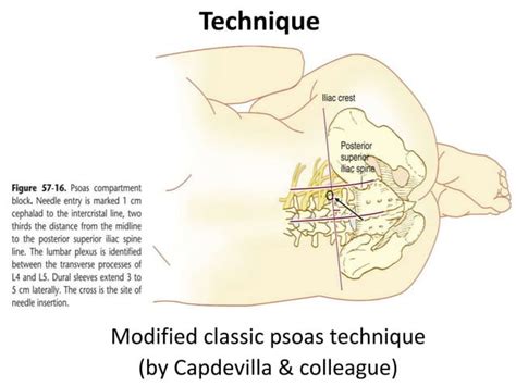 Pnb Of Lower Limb And Paravertebral Block Pptx