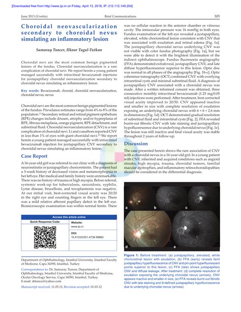Pdf Choroidal Neovascularization Secondary To Choroidal Nevus Simulating An Inflammatory Lesion