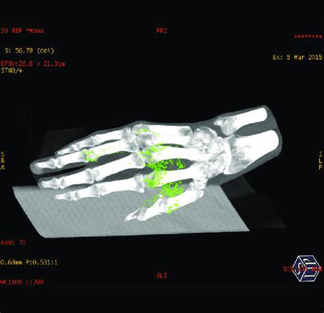 Dect Scan After Two Years Of Treatment Figure 4 Dect Scan After Two Download Scientific