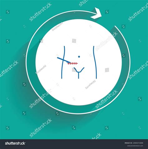 Open Appendectomy Surgery Key Information Guidance Stock Vector
