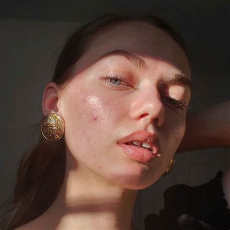 How To Get Rid Of Pimples