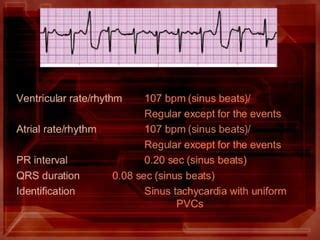 Basic Arrythmias PPT