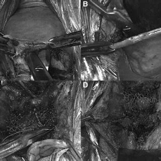 Mesh Fixation At Vaginal Cuff A Separating The Anterior Wall Of The Download Scientific