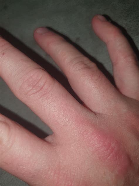 Bumps Forming On Skin Rsteroidsuk