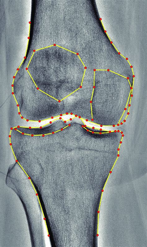 Statistical Shape Model Knee Definition Of The Statistical Shape