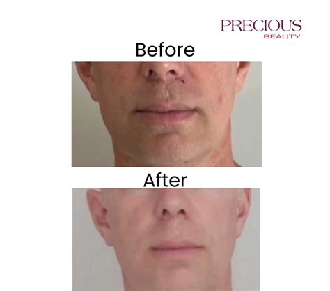 Full Face Hifu Anti Aging Treatment Precious Beauty Mornington Peninsula