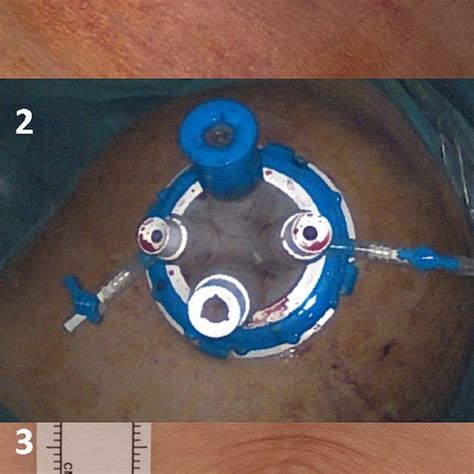 Part 1 Transumbilical 3 Cm Incision Part 2 Single Incision Download Scientific Diagram