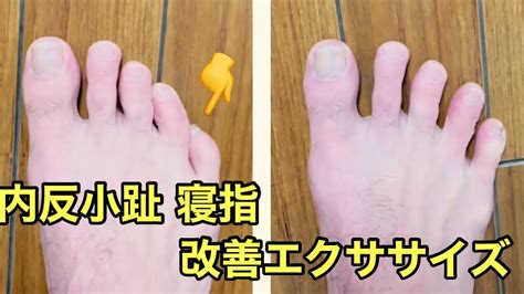 内反小趾 寝指 改善エクササイズ YouTube