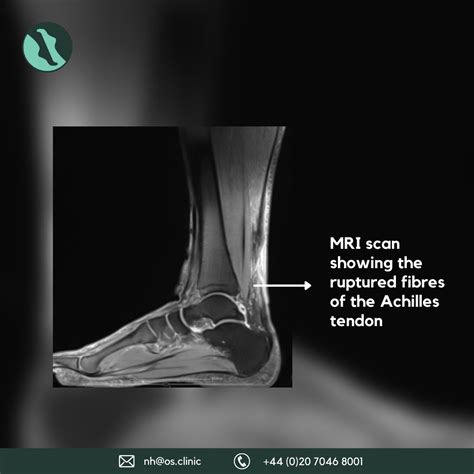 Achilles Tendon Tear X Ray